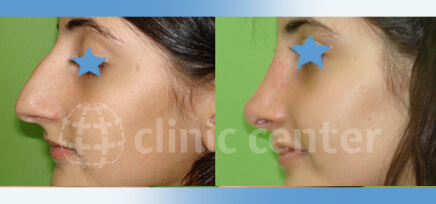Nose Job Before and After | Gallery | Clinic Center