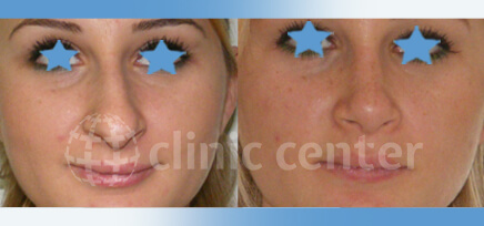 Nose Job Before and After | Gallery | Clinic Center