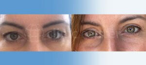 Blepharoplasty in Turkey | Clinic Center