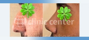 Affordable Nose Job in Turkey: Top Rhinoplasty Surgeons & All-Inclusive ...
