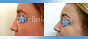 Affordable Nose Job in Turkey: Top Rhinoplasty Surgeons & All-Inclusive ...