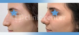 Affordable Nose Job in Turkey: Top Rhinoplasty Surgeons & All-Inclusive ...