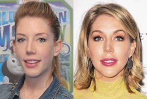 Katherine Ryan Cosmetic Surgeries